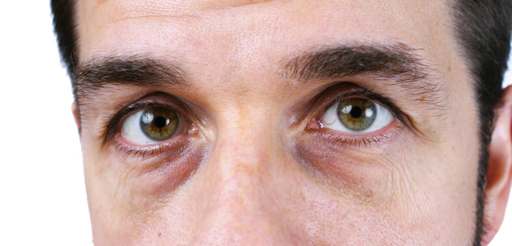 Dark Circles Under the Eyes- Why We Have Them and How To Treat Them ...
